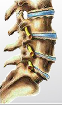 degenerative disc disease